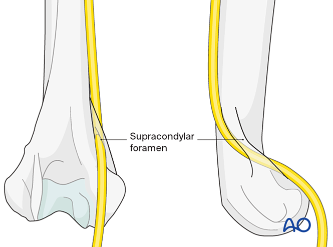 Medial approach to the dog humeral shaft