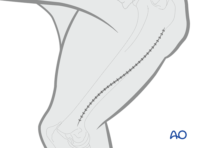 Medial approach to the dog humeral shaft