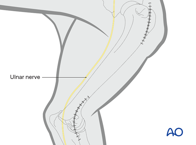 Minimally invasive approach to the dog humeral shaft