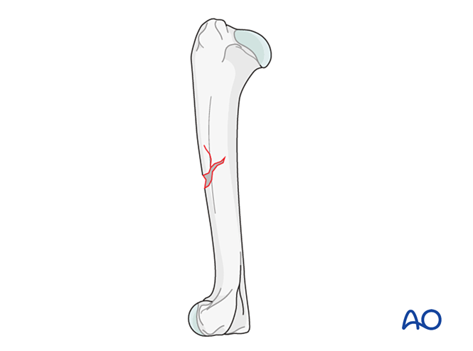 Nonoperative treatment for Incomplete fracture of the dog humeral diaphysis