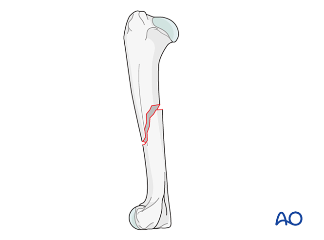 Simple oblique fracture of the humeral diaphysis