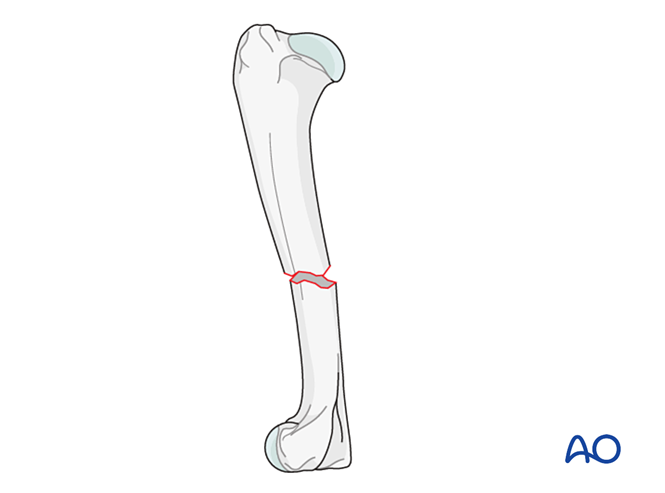 Simple transverse fracture of the dog humeral diaphysis
