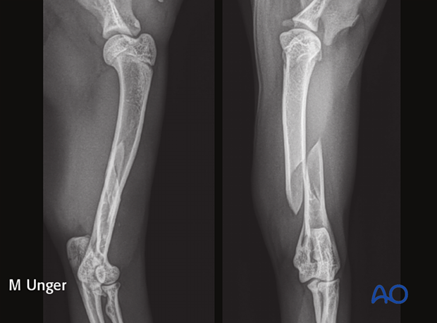 Simple oblique fracture of the dog humeral diaphysis