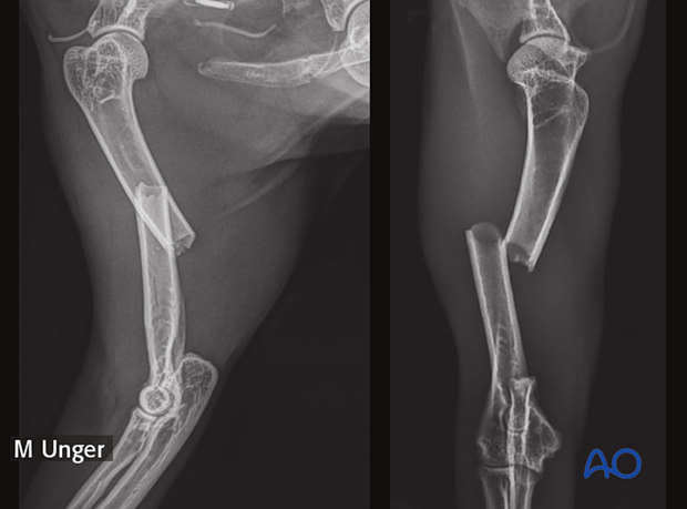 Simple transverse fracture of the dog humeral diaphysis