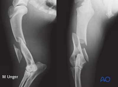 Dog humeral diaphyseal fracture with one reducible wedge
