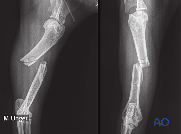 Dog humeral diaphyseal fracture with non-reducible wedge