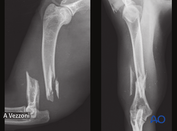 Dog humeral diaphyseal fracture with non-reducible wedge