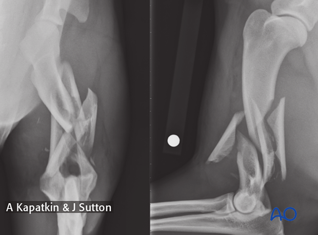 Humeral diaphyseal fractures with complex non-reducible wedges