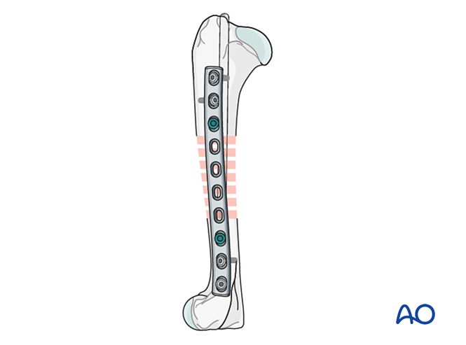 Bridging plate and pin for Simple oblique fracture of the dog humeral ...