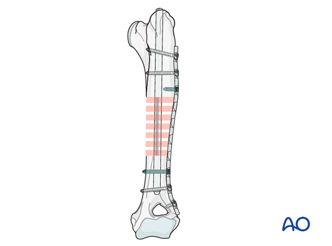 Bridging plate and pin for Complex segmental dog humeral diaphyseal ...