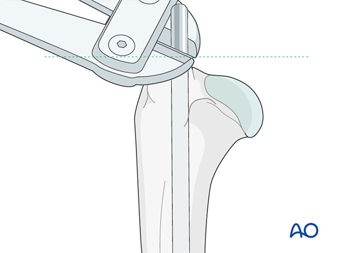 Bridging plate and pin for Complex segmental dog humeral diaphyseal ...