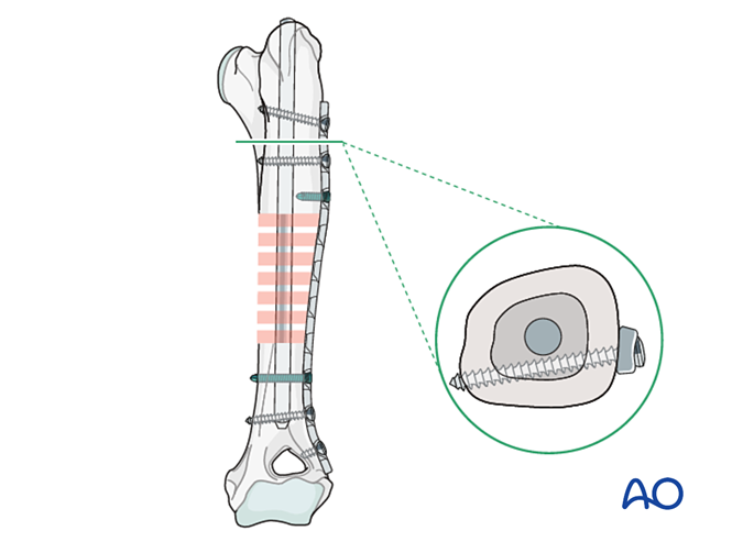 Bridging plate and pin for Complex segmental dog humeral diaphyseal ...