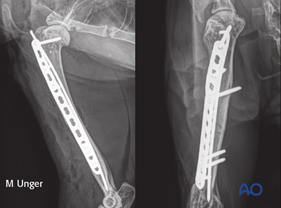 Bridging plate and pin for Dog humeral diaphyseal fracture with complex ...