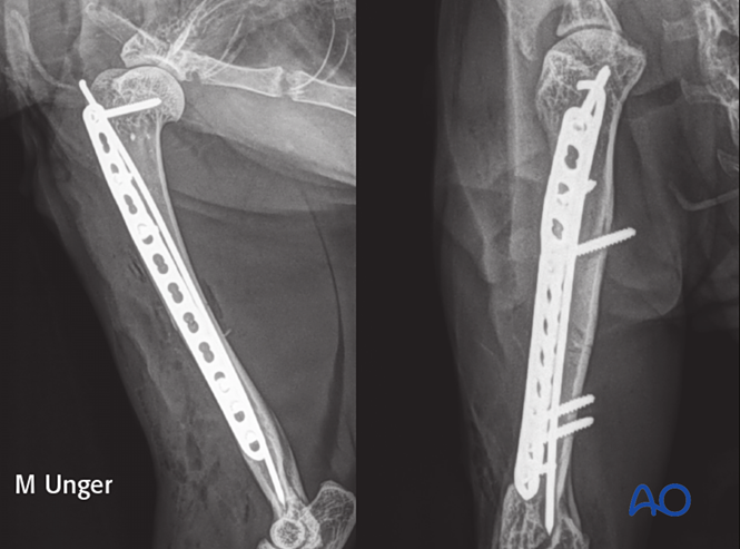 Bridging plate and pin for Complex segmental dog humeral diaphyseal ...