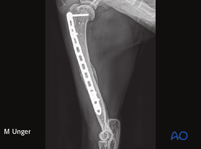 Bridging plate and pin for Dog humeral diaphyseal fracture with complex ...