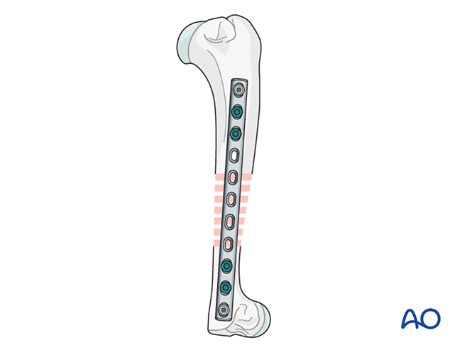 Bridging plate for Dog humeral diaphyseal fracture with complex non ...