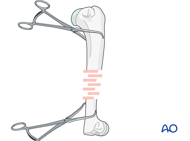 Bridging plate for Dog humeral diaphyseal fracture with several ...