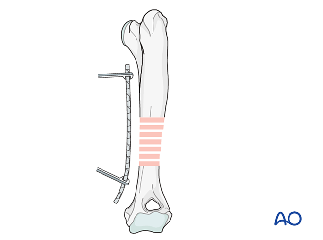 Bridging plate for Dog humeral diaphyseal fracture with complex non ...