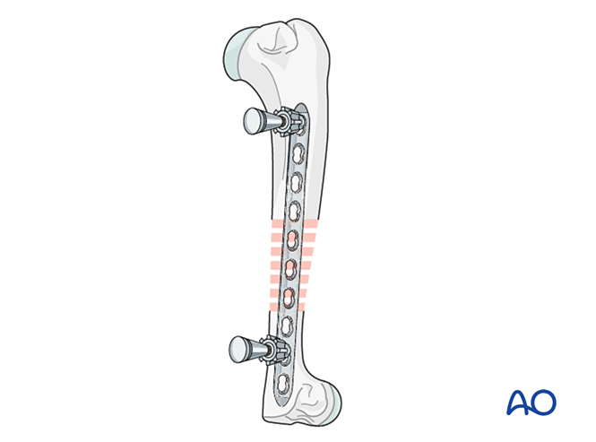 Bridging plate for Dog humeral diaphyseal fracture with complex non ...