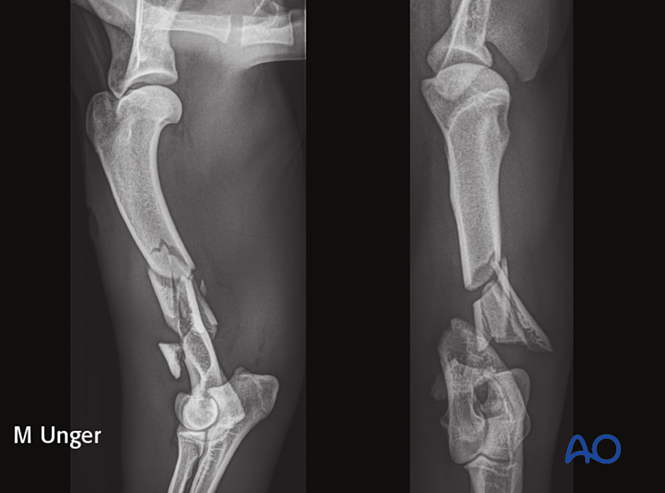 Bridging plate for Dog humeral diaphyseal fracture with several ...