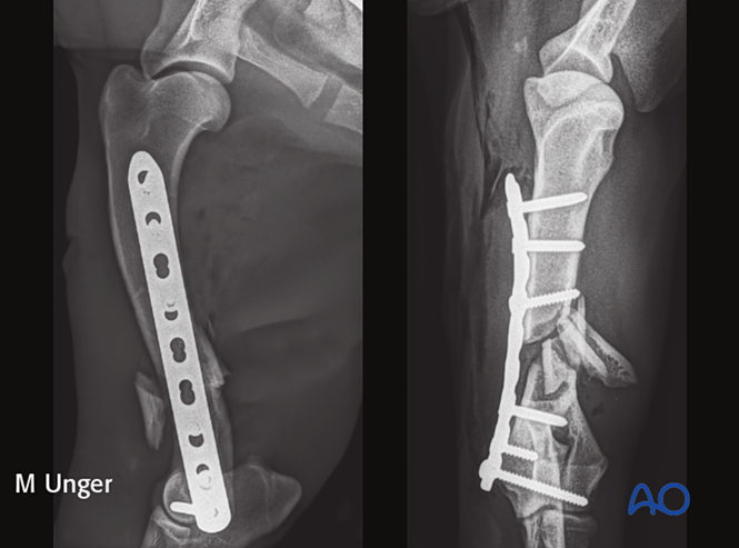 Bridging plate for Dog humeral diaphyseal fracture with complex non ...