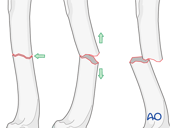 Compression plate for Simple transverse fracture of the dog humeral ...