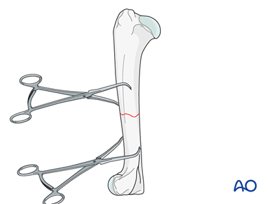 Compression plate for Simple transverse fracture of the dog humeral ...