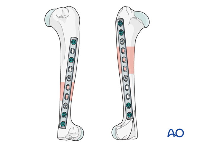 Compression plate for Simple transverse fracture of the dog humeral ...