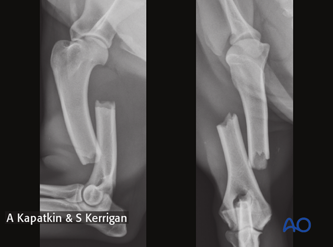 Compression plate for Simple transverse fracture of the dog humeral ...