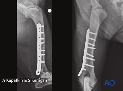 Compression plate for Simple transverse fracture of the dog humeral ...