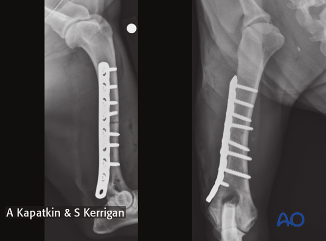 Compression plate for Simple transverse fracture of the dog humeral ...
