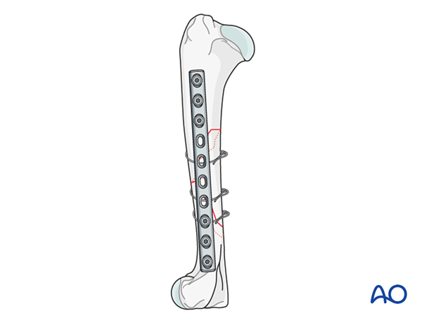 Cerclage wires and neutralization plate for Dog humeral diaphyseal ...