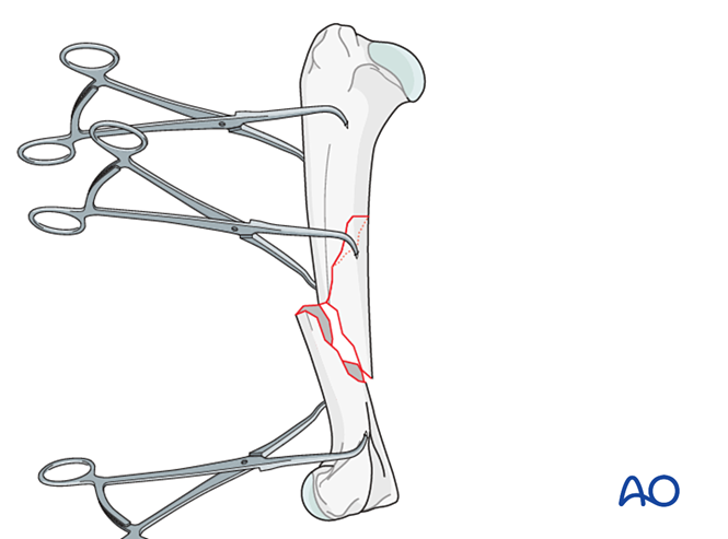 Cerclage wires and neutralization plate for Dog humeral diaphyseal ...
