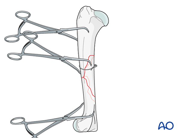 Cerclage wires and neutralization plate for Dog humeral diaphyseal ...