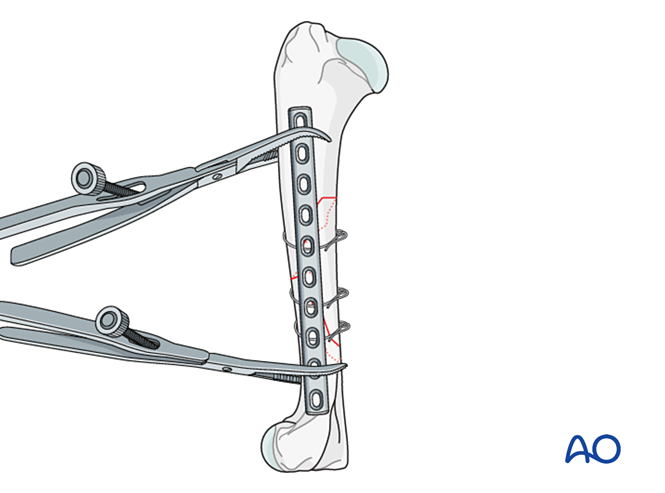 Cerclage wires and neutralization plate for Dog humeral diaphyseal ...