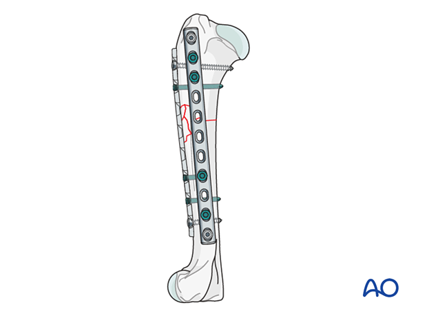Double plating for Humeral diaphyseal fracture with non-reducible wedge