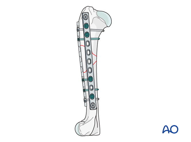 Double plating for Complex segmental dog humeral diaphyseal fracture