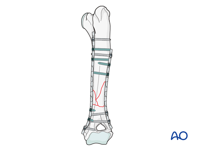 Double plating for Humeral diaphyseal fracture with complex reducible ...