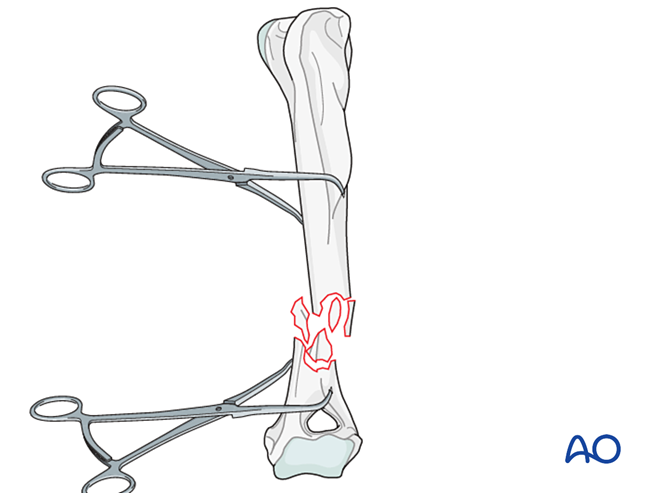 Double plating for Dog humeral diaphyseal fracture with non-reducible wedge