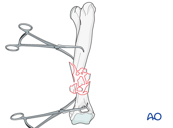 Double plating for Dog humeral diaphyseal fracture with complex non ...