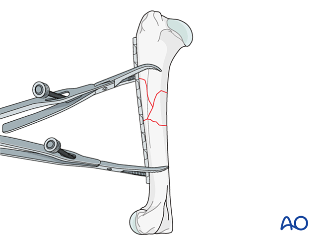 Double plating for Dog humeral diaphyseal fracture with complex ...