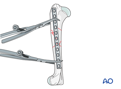 Double plating for Dog humeral diaphyseal fracture with complex non ...