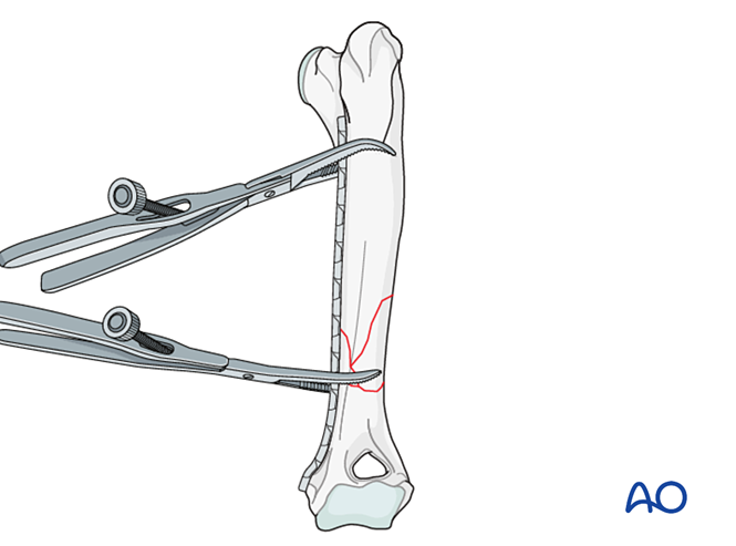 Double plating for Dog humeral diaphyseal fracture with complex ...