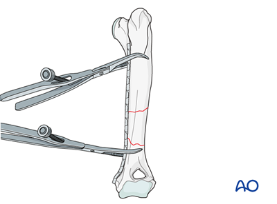 Double plating for Complex segmental dog humeral diaphyseal fracture