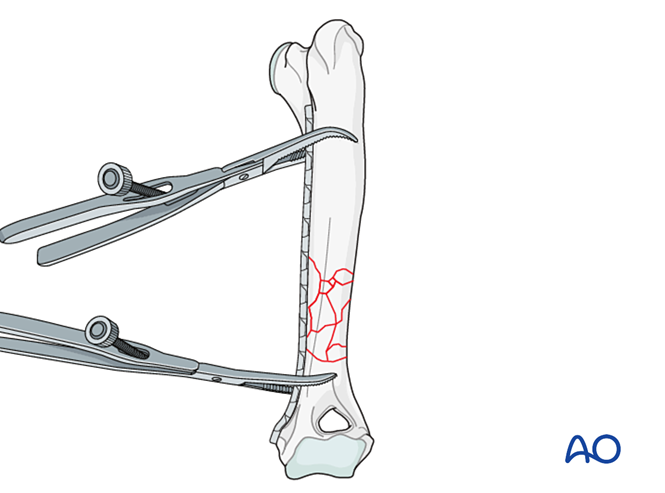 Double plating for Dog humeral diaphyseal fracture with complex non ...