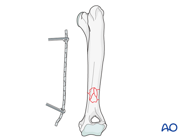Double plating for Humeral diaphyseal fracture with non-reducible wedge