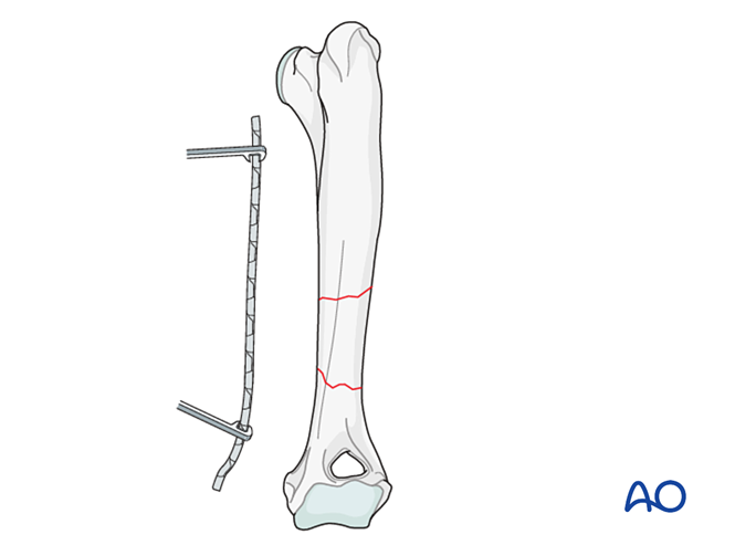 Double plating for Complex segmental dog humeral diaphyseal fracture