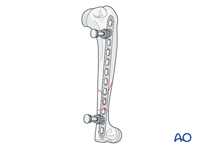 Double plating for Dog humeral diaphyseal fracture with complex ...