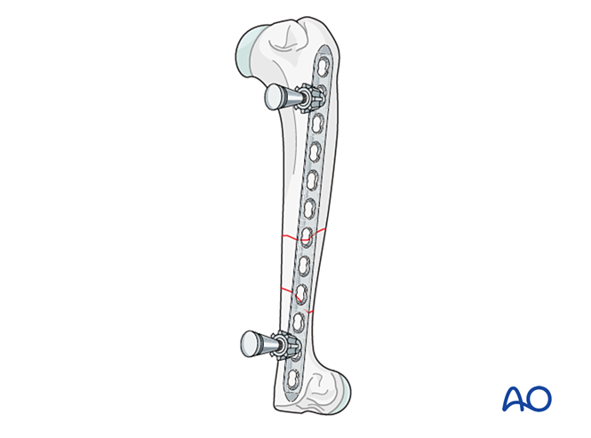 Double plating for Complex segmental dog humeral diaphyseal fracture