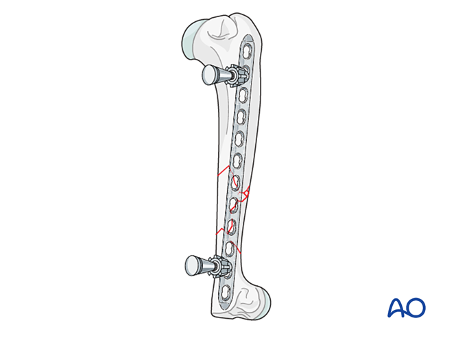 Double plating for Dog humeral diaphyseal fracture with complex non ...